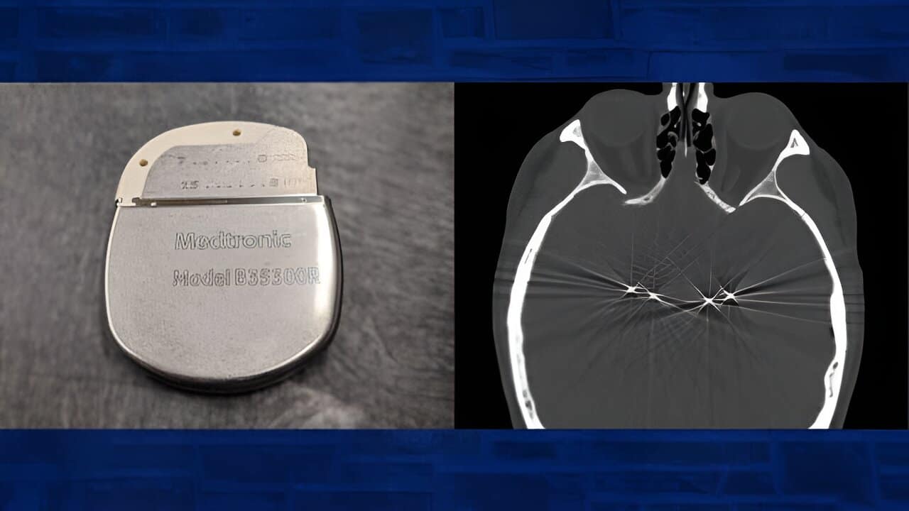 Transforming Parkinson's Treatment: Duke Engineers Unveil Smart Deep ...